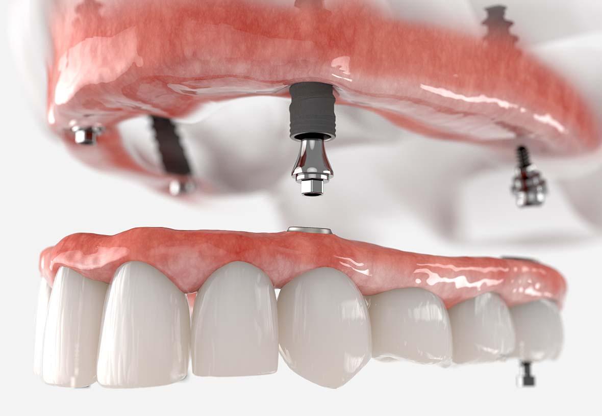 Implant Supported Dentures in South End Halifax | Davidson Dental
