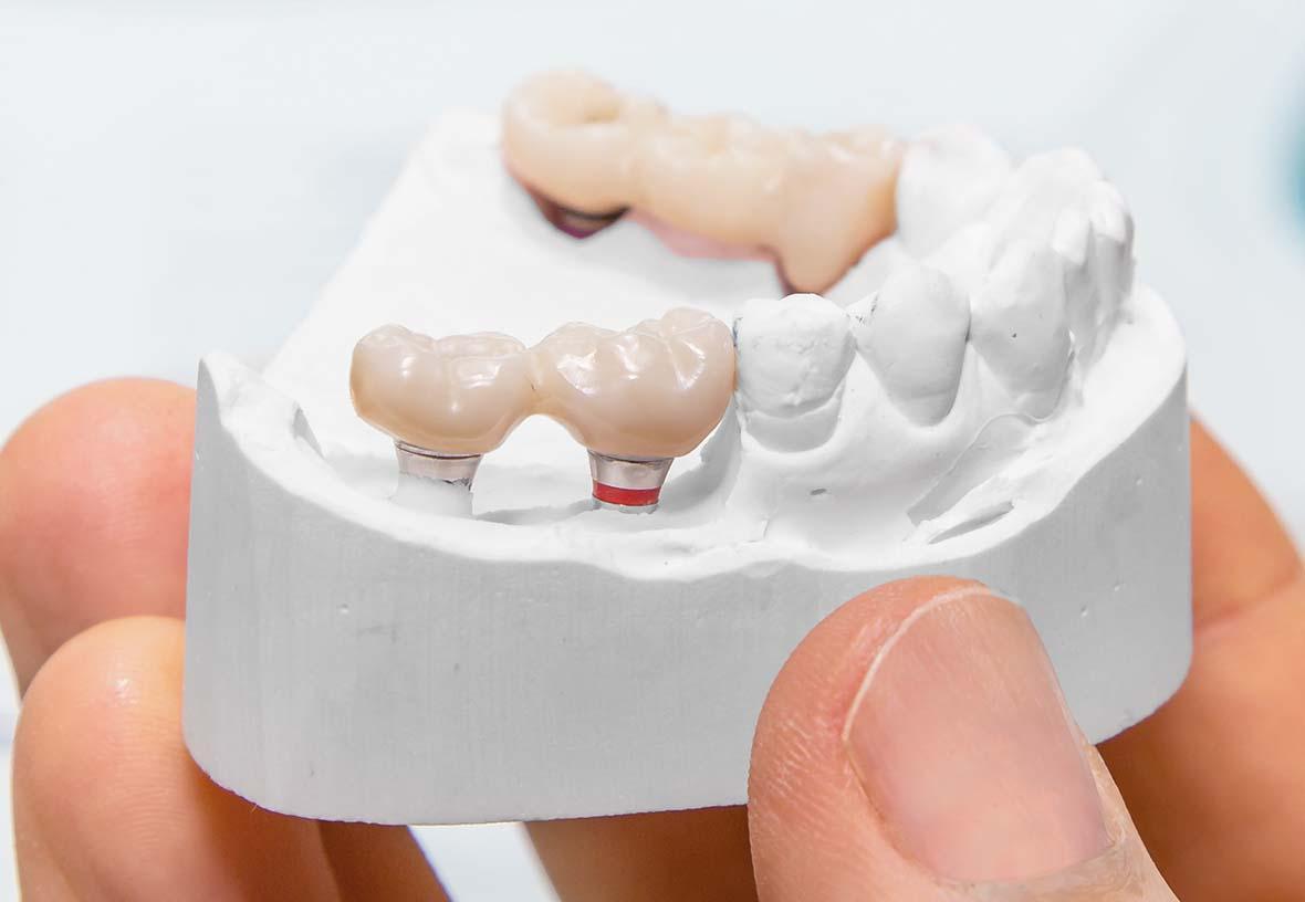 Implant Supported Dentures in South End Halifax | Davidson Dental