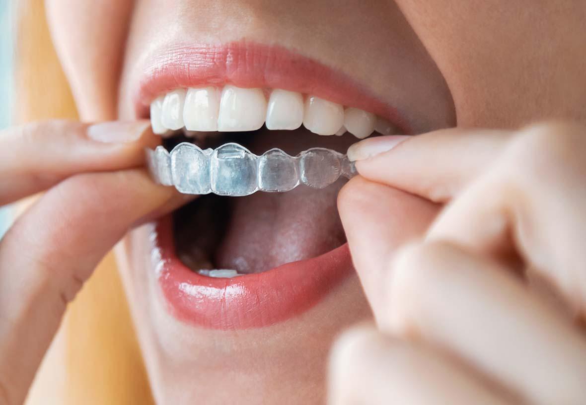 Orthodontics & Invisalign® in South End Halifax | Davidson Dental